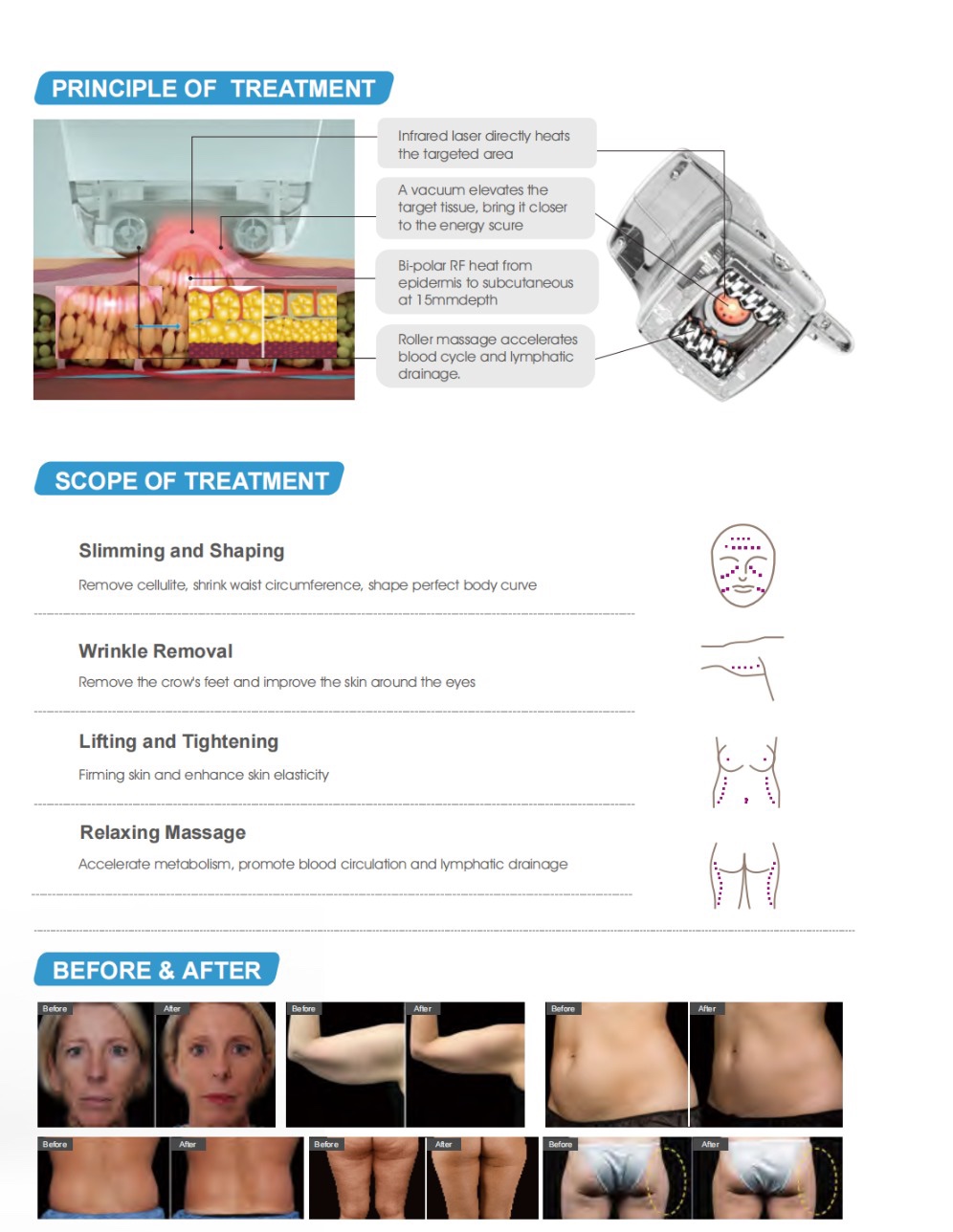 2024 New Infrared RF Vacuum Roller Machine - Phoenix